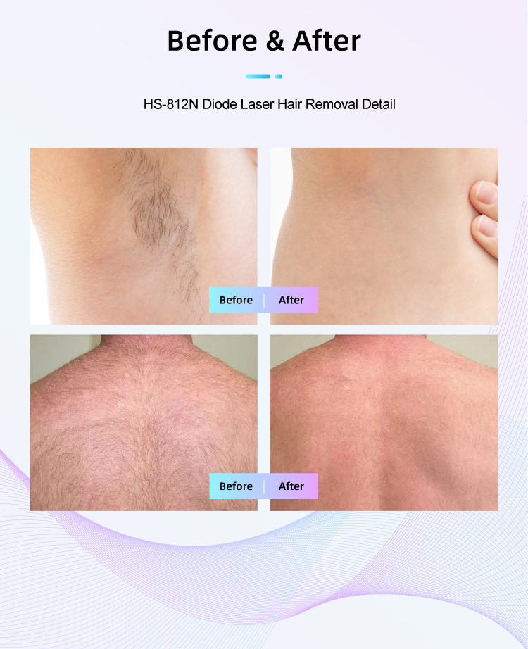 fda approved diode laser machine HS-812 - Apolomed