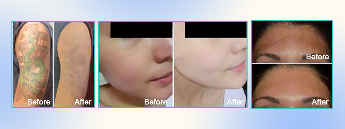 Electro-optic q switched nd yag laser for tattoo removal HS-255 - Apolomed